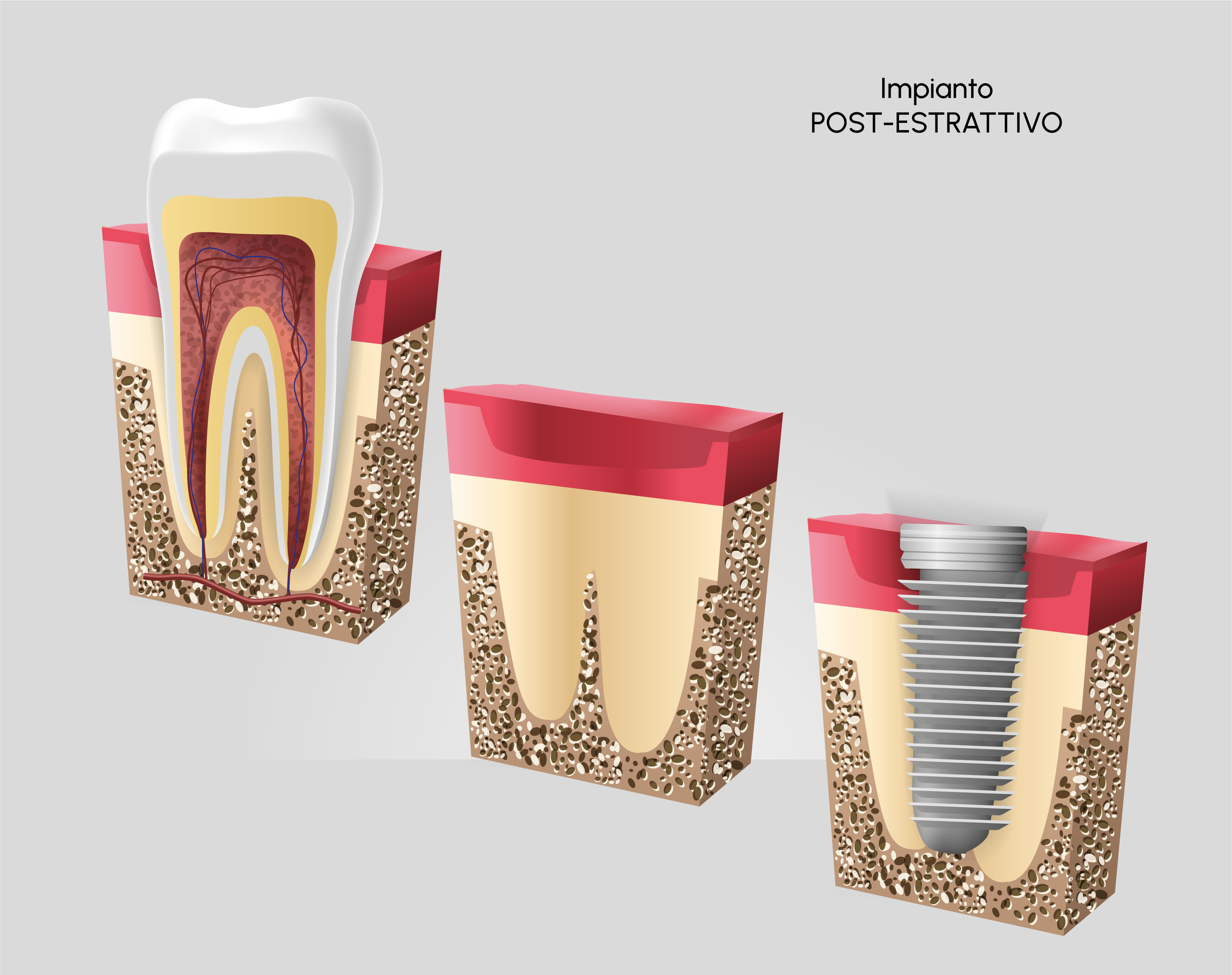 Implantologia dentale: facciamo chiarezza - Centro Medico San Michele - Corato Bari